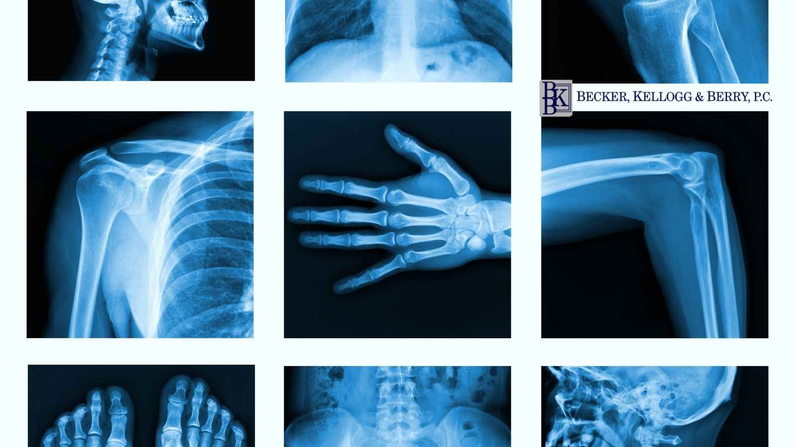 Car accidents can cause bones to break throughout the body | Becker ...